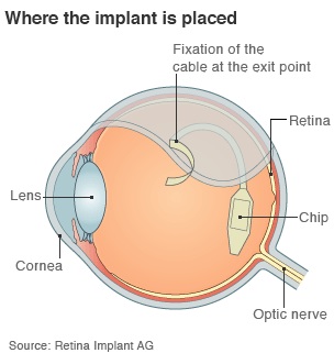Eye Chip Implant 'Helps Blind People See' | RealClearScience